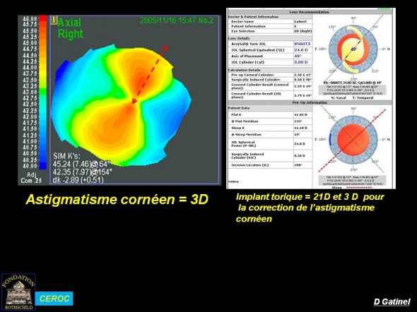 Implant torique - Docteur Damien Gatinel