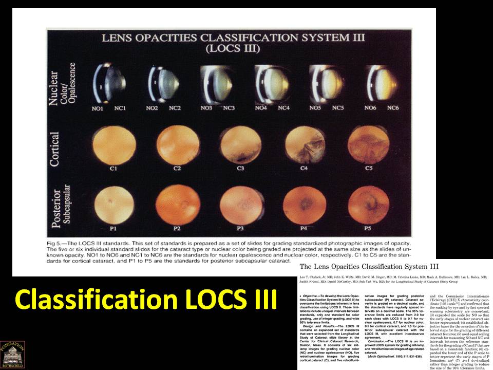 Classification LOCS III site gatinel.com - Docteur Damien Gatinel