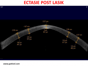 Ectasie Cornéenne - Docteur Damien Gatinel