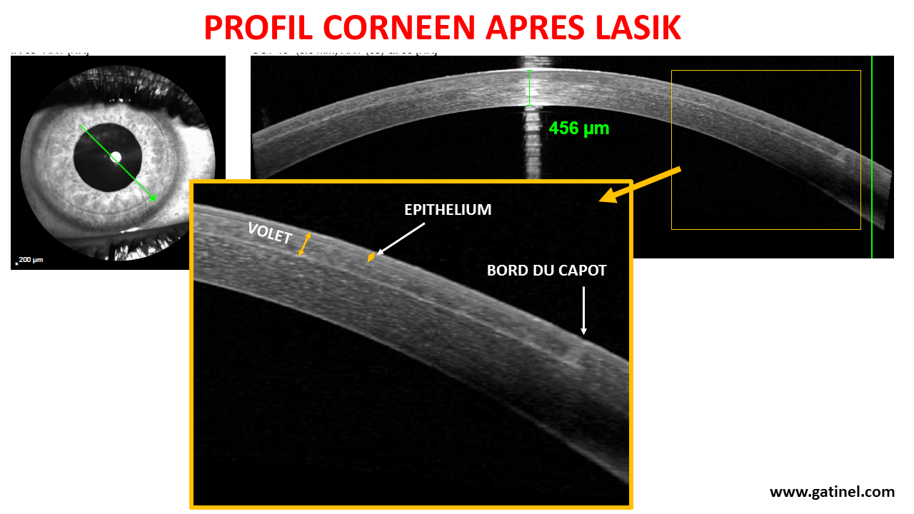LASIK définition principes technique