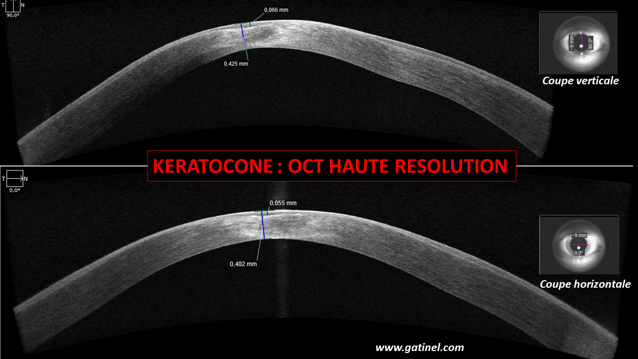 Kératocône - Docteur Damien Gatinel