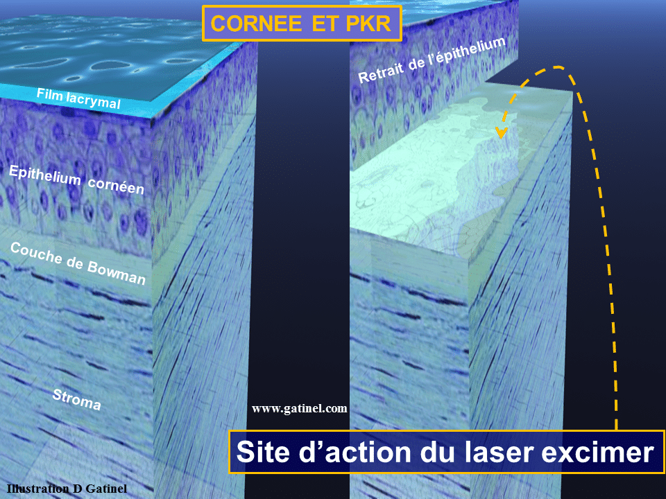 La PKR (laser de surface) - Docteur Damien Gatinel