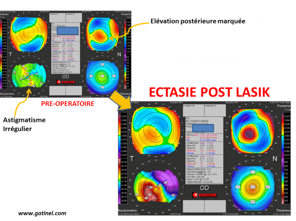 Ectasie Cornéenne - Docteur Damien Gatinel