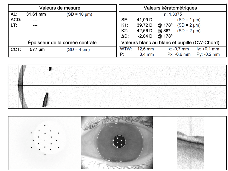 Angle Kappa - Docteur Damien Gatinel