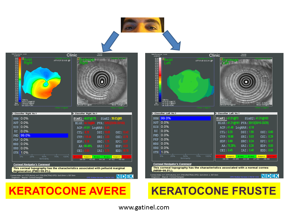 Kératocône fruste - kératocône forme fruste - Dr Damien Gatinel