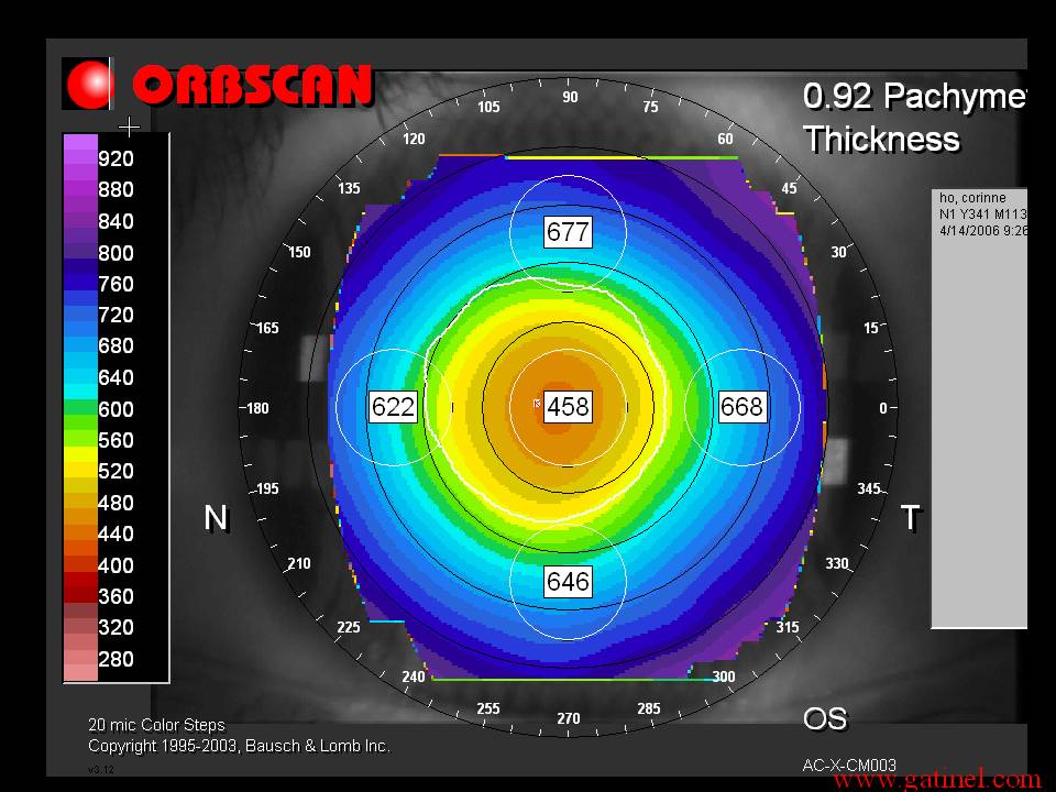 Qu'est ce que l'épaisseur de la cornée ? (pachymétrie cornéenne ...