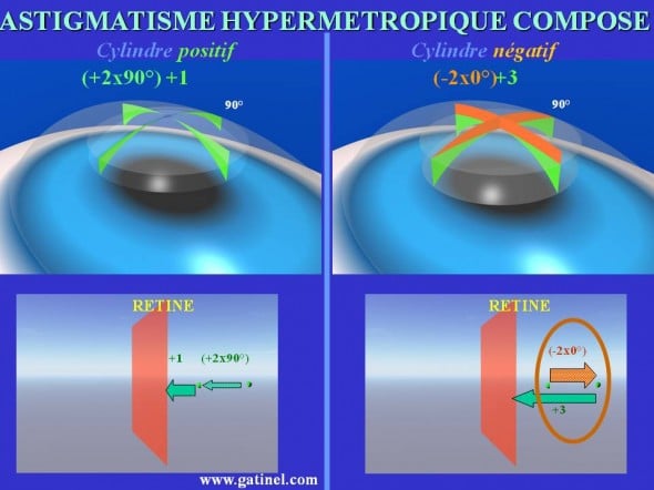Profil d'ablation: astigmatismes composés - Docteur Damien Gatinel