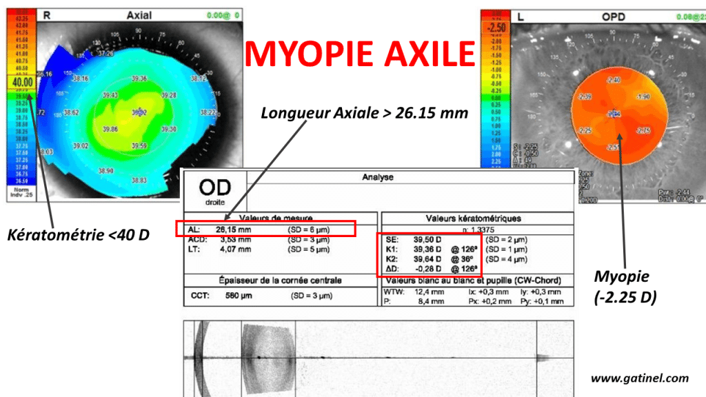 Myopie - Docteur Damien Gatinel