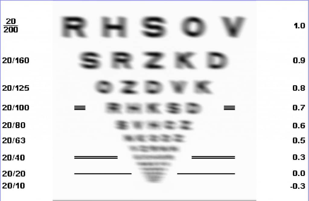 Astigmatisme - Docteur Damien Gatinel