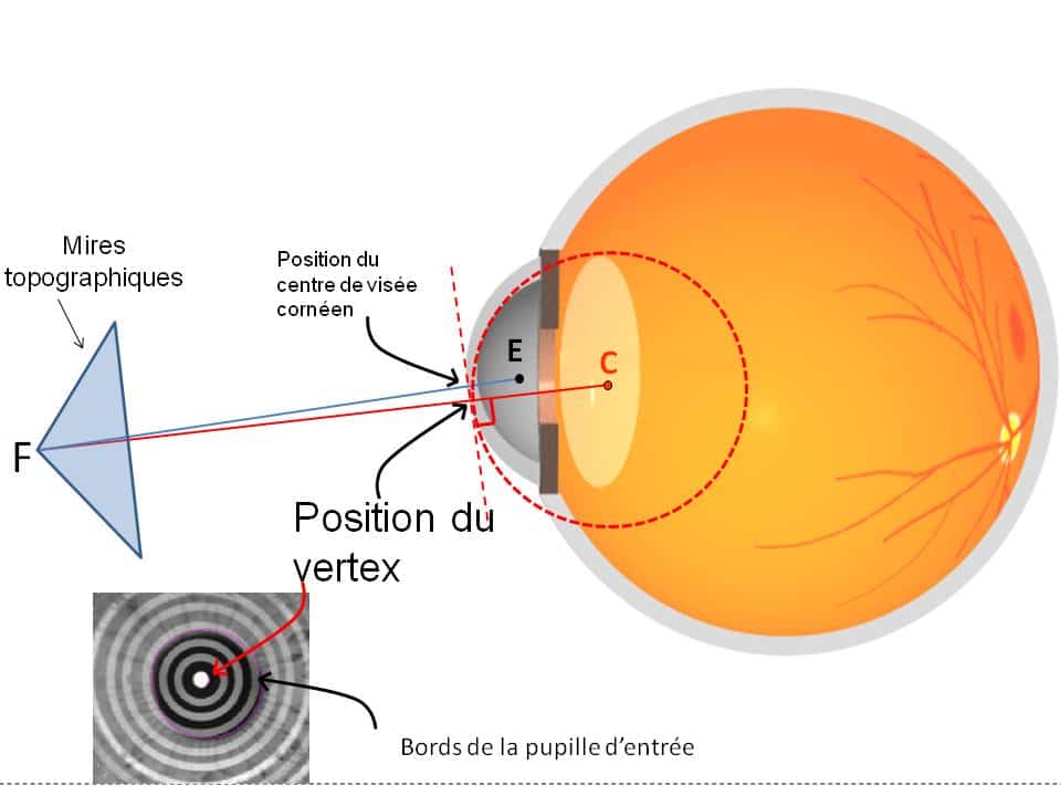 Qu'est ce que l'axe kératométrique ? - Docteur Damien Gatinel