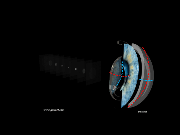 Implant torique - Docteur Damien Gatinel