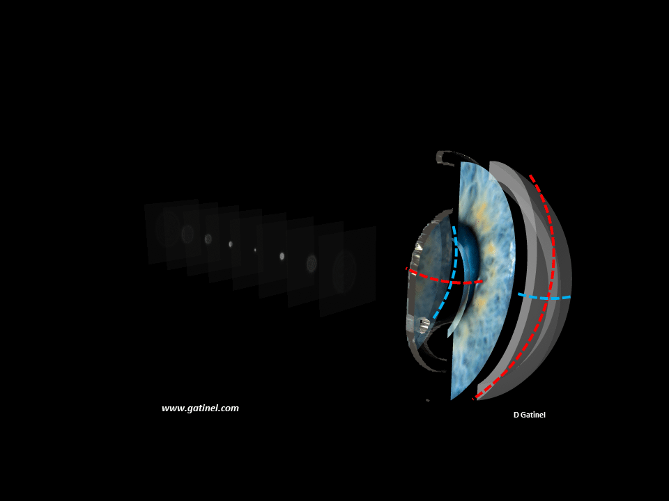 Implant torique - Docteur Damien Gatinel