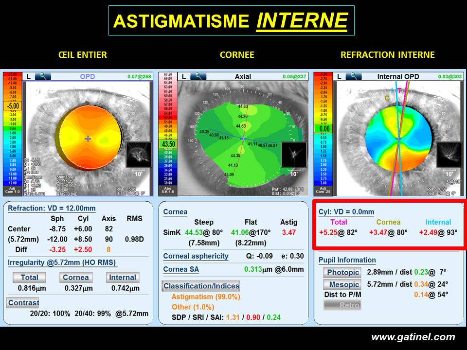 Astigmatisme régulier et irrégulier - Docteur Damien Gatinel