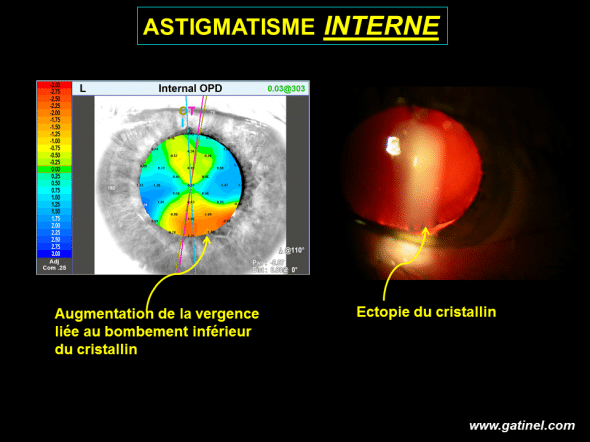 Astigmatisme régulier et irrégulier - Docteur Damien Gatinel