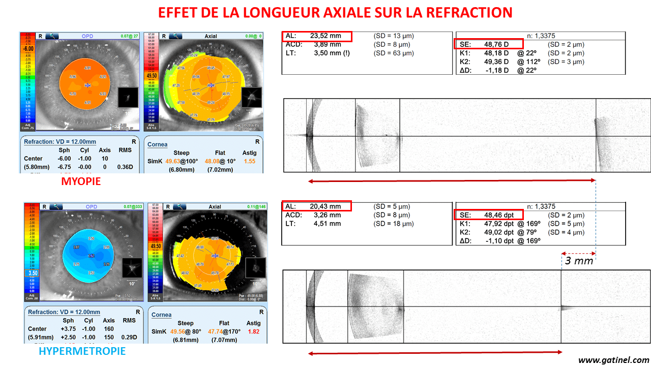 Myopie: réfraction et longueur axiale - Docteur Damien Gatinel