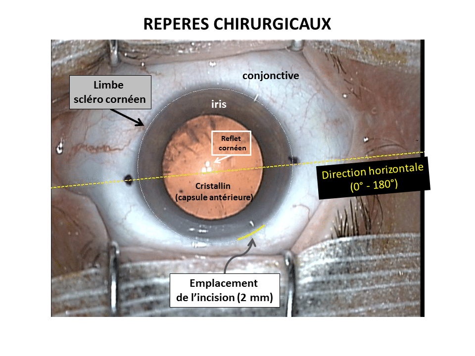 Chirurgie de la cataracte en images - Docteur Damien Gatinel