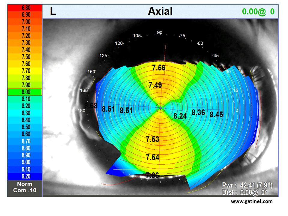 Astigmatisme cornéen - Docteur Damien Gatinel