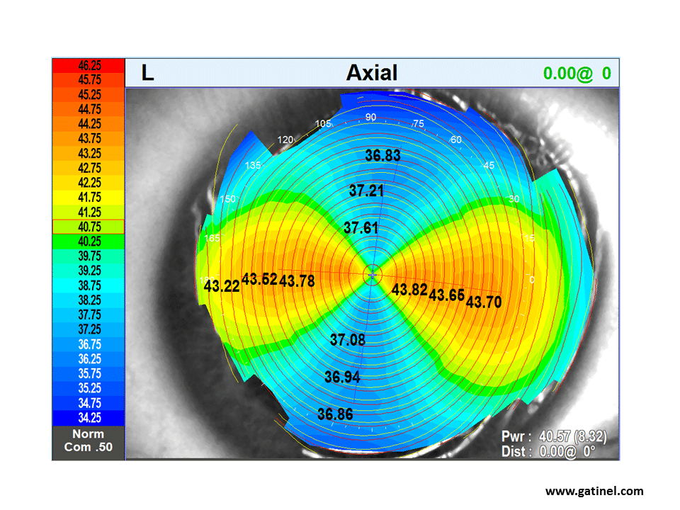 Astigmatisme cornéen - Docteur Damien Gatinel
