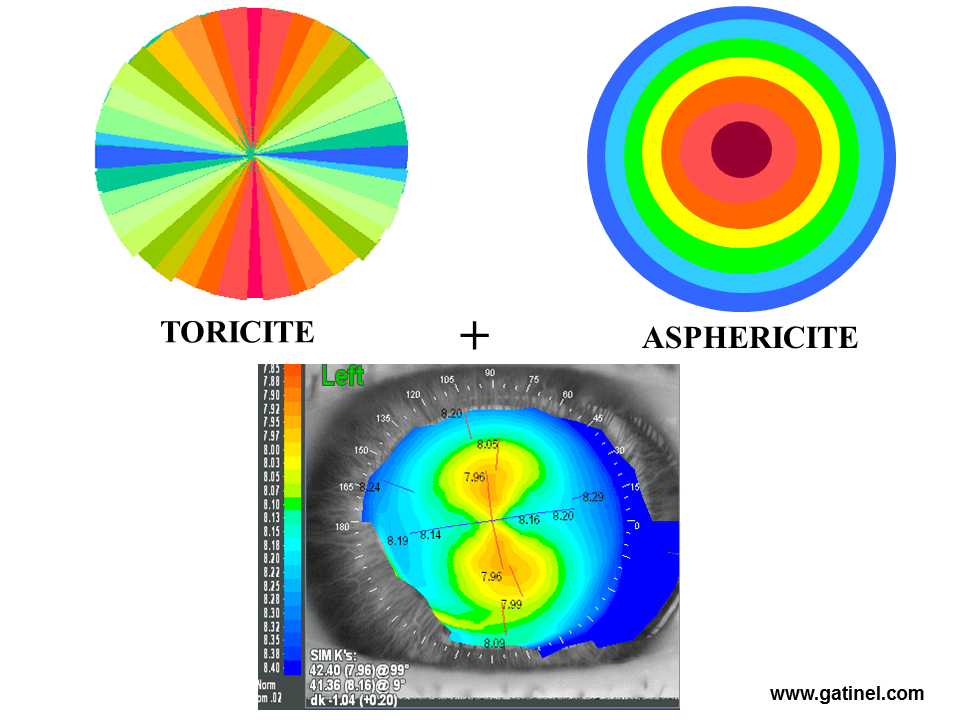 Astigmatisme cornéen - Docteur Damien Gatinel