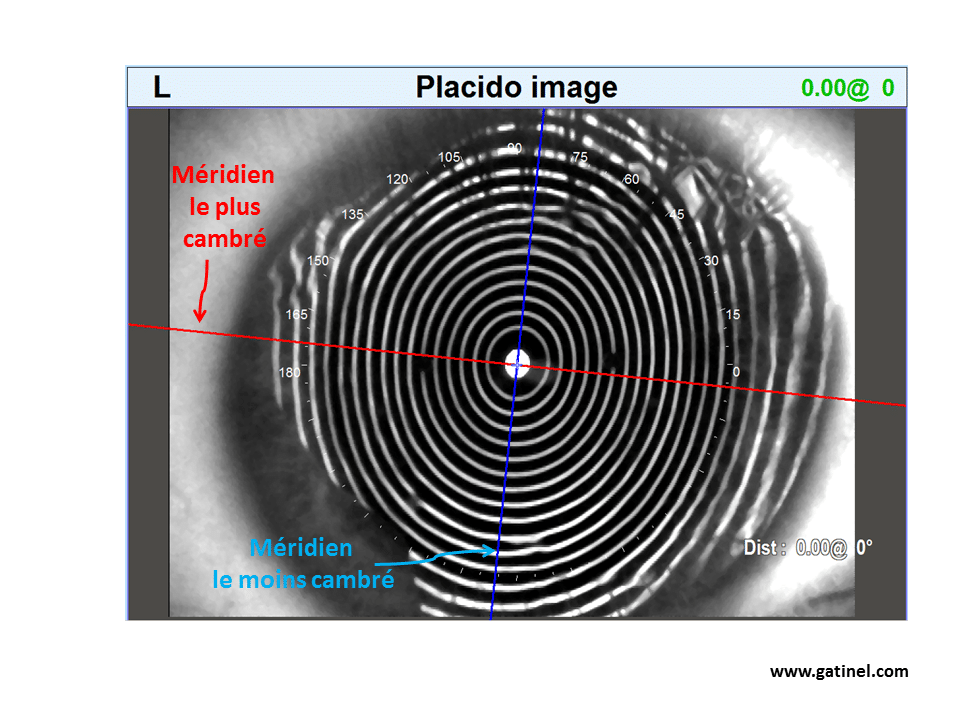 Astigmatisme cornéen - Docteur Damien Gatinel