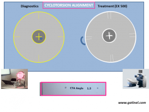 Centering corneal laser surgery (LASIK/PRK) with the Alcon/Wavelight EX ...