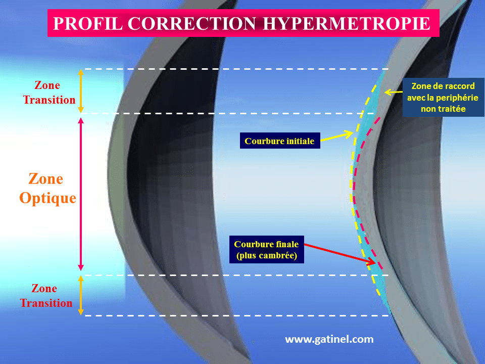 LASIK et hypermétropie - Docteur Damien Gatinel