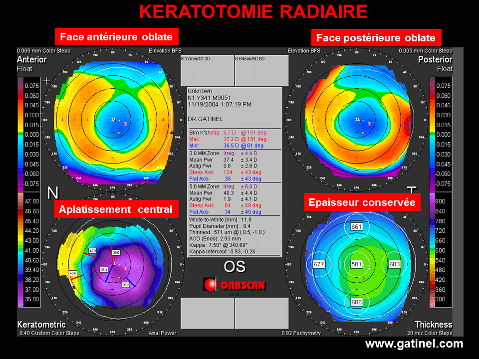 PKR pour hypermétropie après kératotomie radiaire