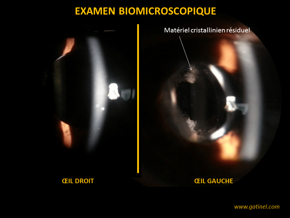 Influence de la position effective de l’implant sur la réfraction ...