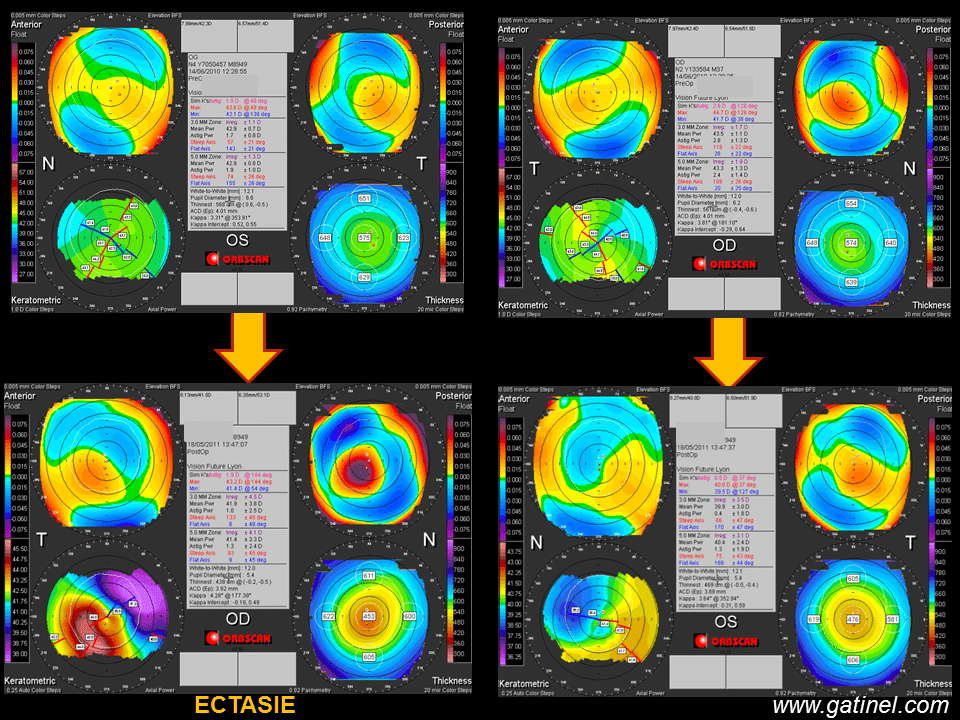 SCORE Analyzer - Docteur Damien Gatinel