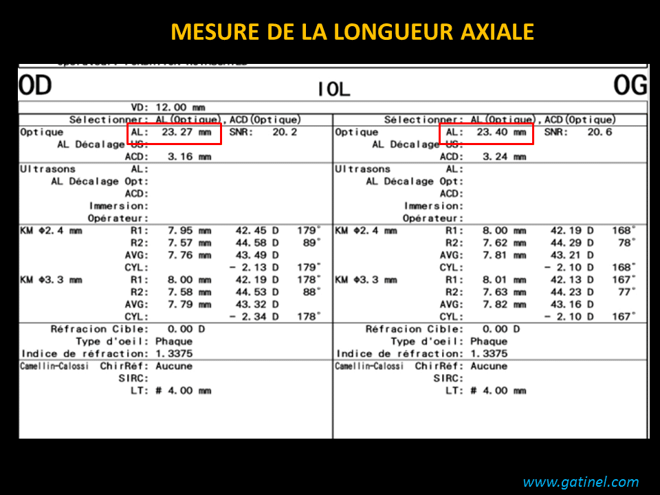 Aberrations internes et subluxation du cristallin - Docteur Damien Gatinel