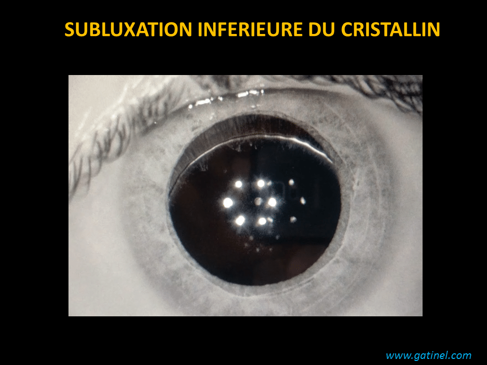 Aberrations internes et subluxation du cristallin - Docteur Damien Gatinel