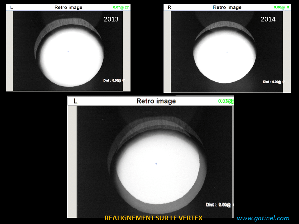 Aberrations internes et subluxation du cristallin - Docteur Damien Gatinel
