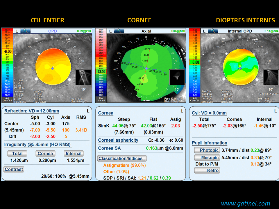 Aberrations internes et subluxation du cristallin - Docteur Damien Gatinel