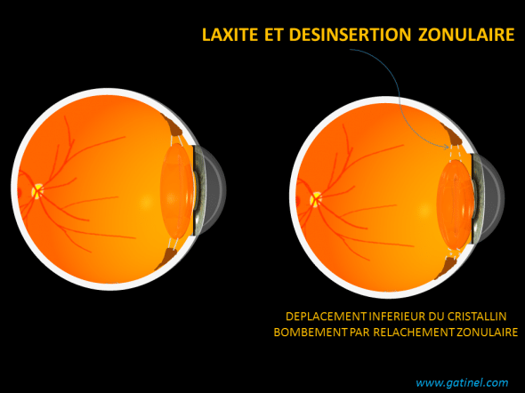 Aberrations internes et subluxation du cristallin - Docteur Damien Gatinel
