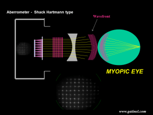 Wavefront sensing - Docteur Damien Gatinel