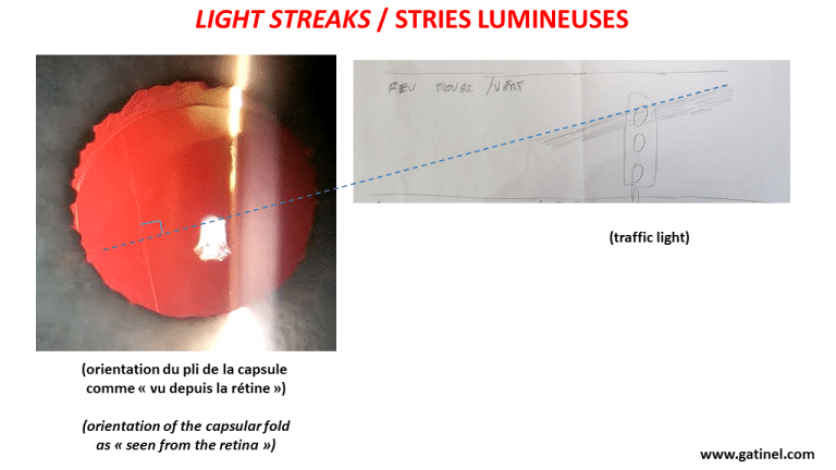 Light streaks / Stries de lumière - Docteur Damien Gatinel