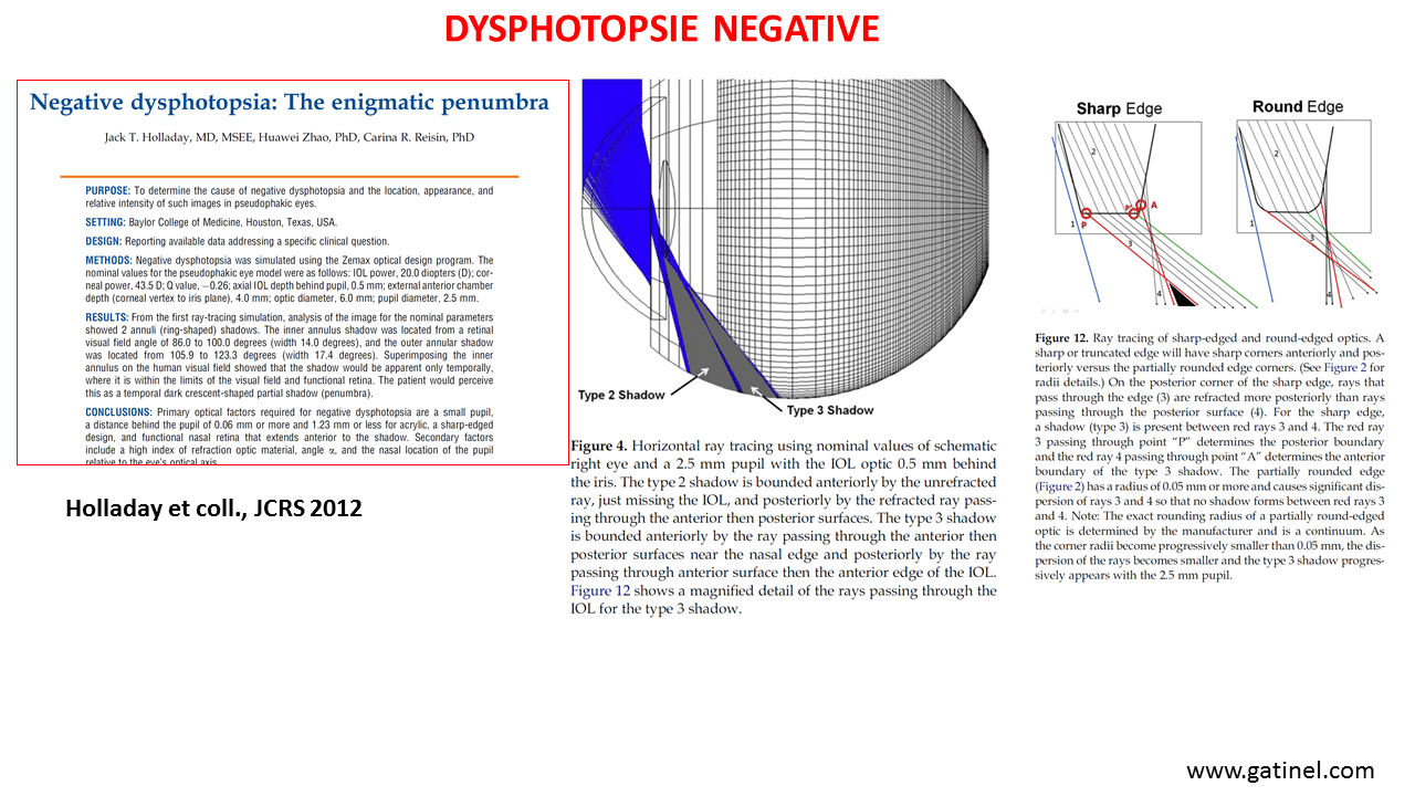 Dysphotopsies - Docteur Damien Gatinel