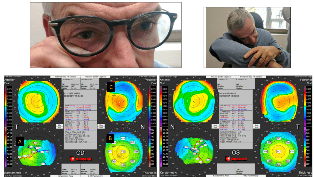 No Rub, no Cone: The Keratoconus Conjecture. - Docteur Damien Gatinel