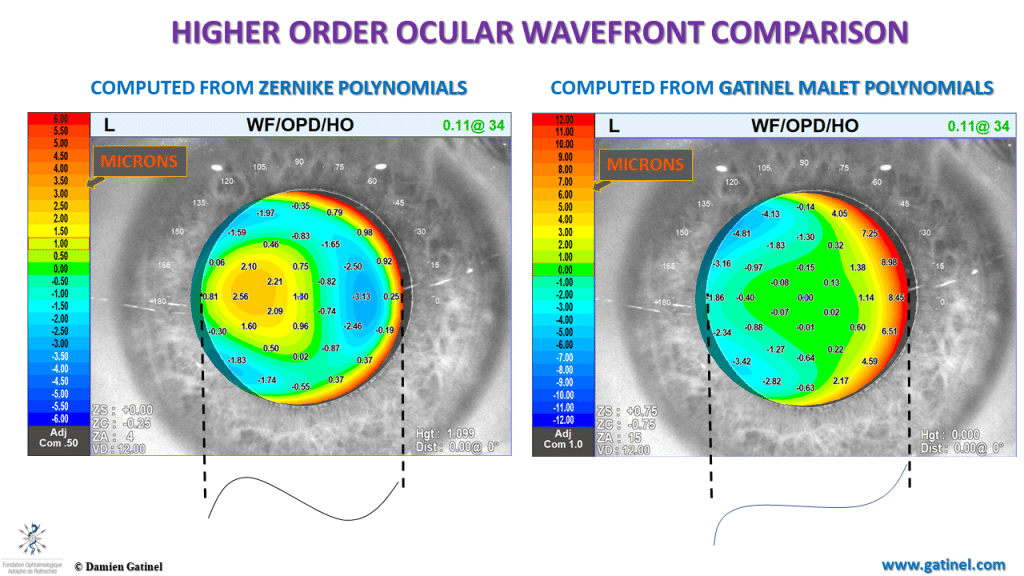 Pre- and Post-LASIK aberrations comparison - Docteur Damien Gatinel