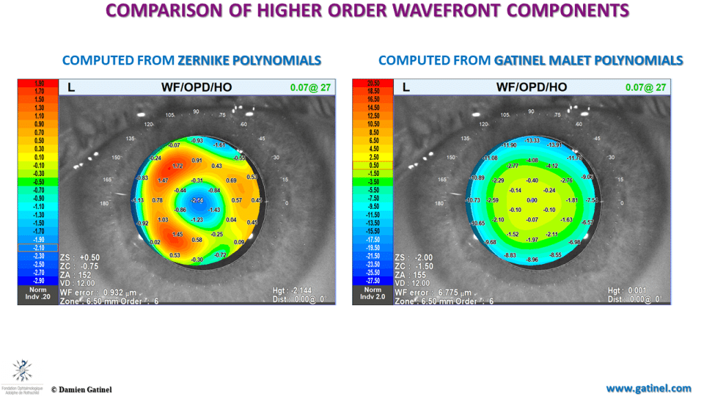 Aberrations post presby-LASIK - Docteur Damien Gatinel