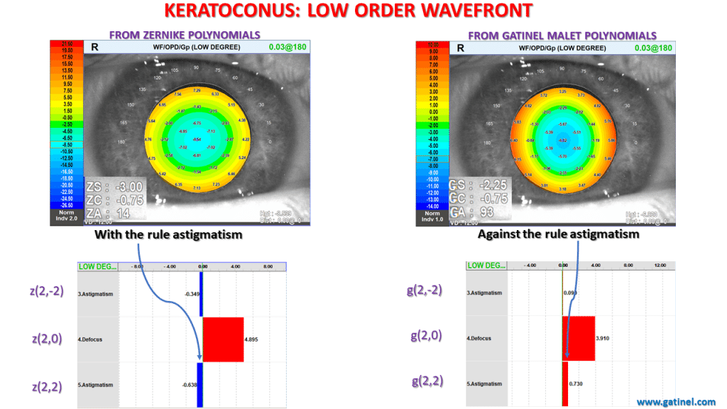 Aberrations in keratoconus - Docteur Damien Gatinel