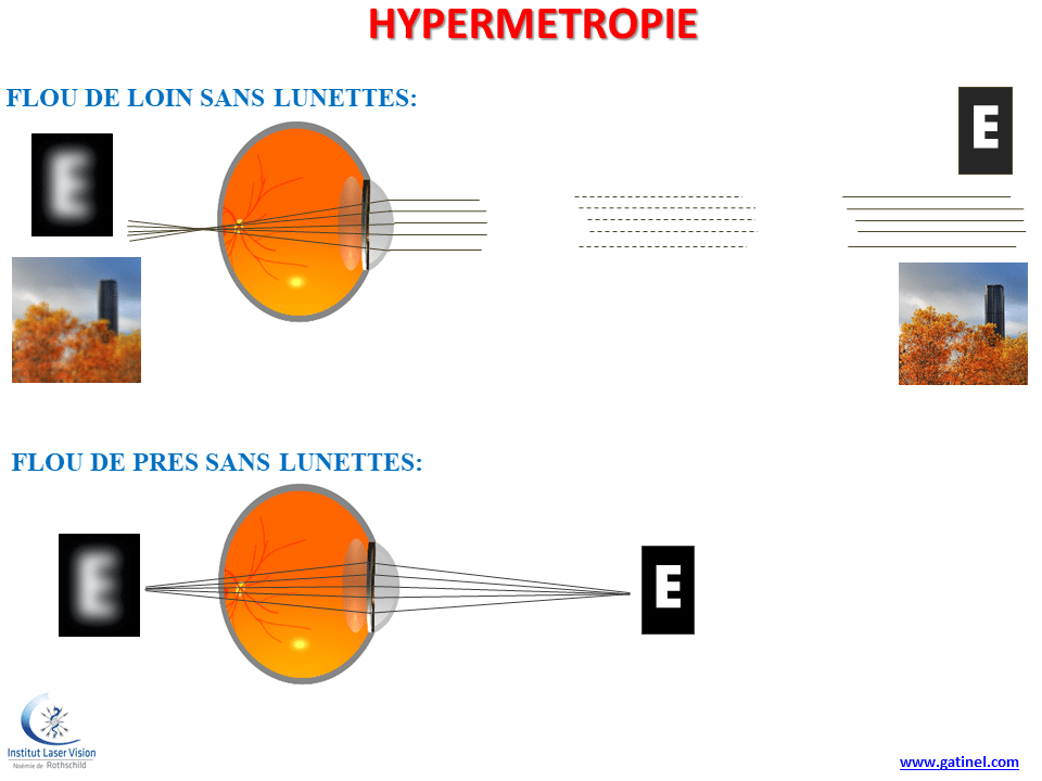 LASIK HYPERMETROPIE +/- PRESBYTIE - Docteur Damien Gatinel