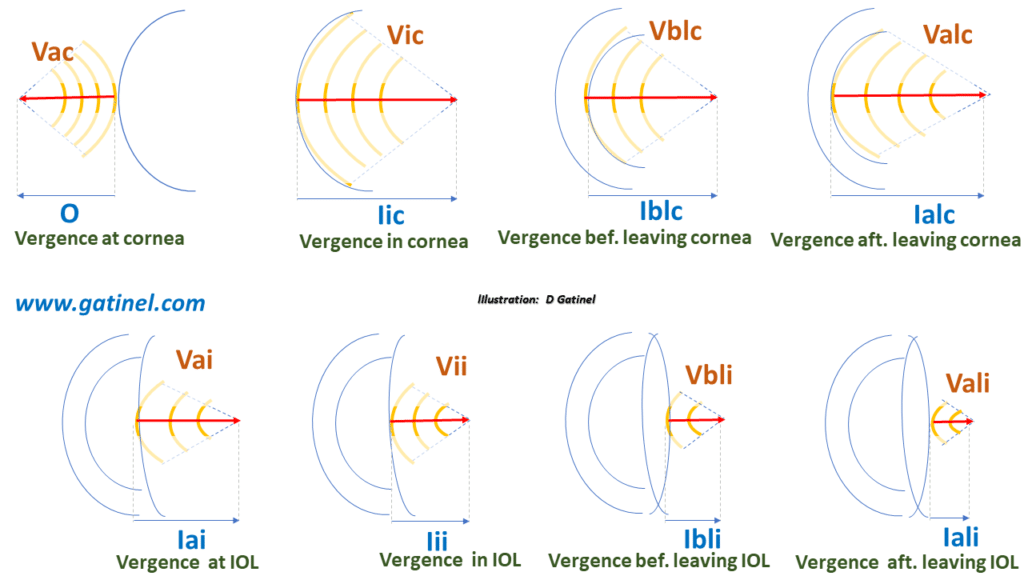 3. Computing vergence in the pseudophakic eye - Docteur Damien Gatinel