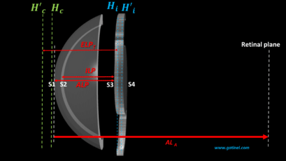 13. Thick lens IOL power calculation - Docteur Damien Gatinel