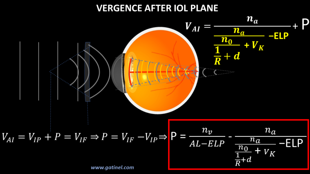 4. Thin lens IOL power computation - Docteur Damien Gatinel
