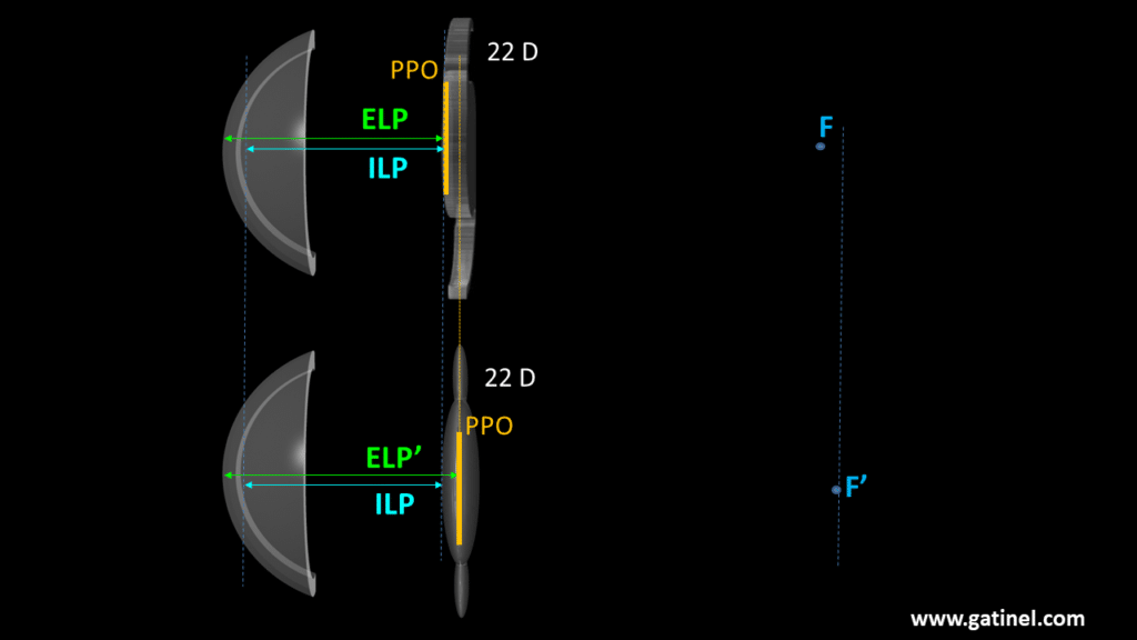 7. Paraxial power of the IOL - Docteur Damien Gatinel