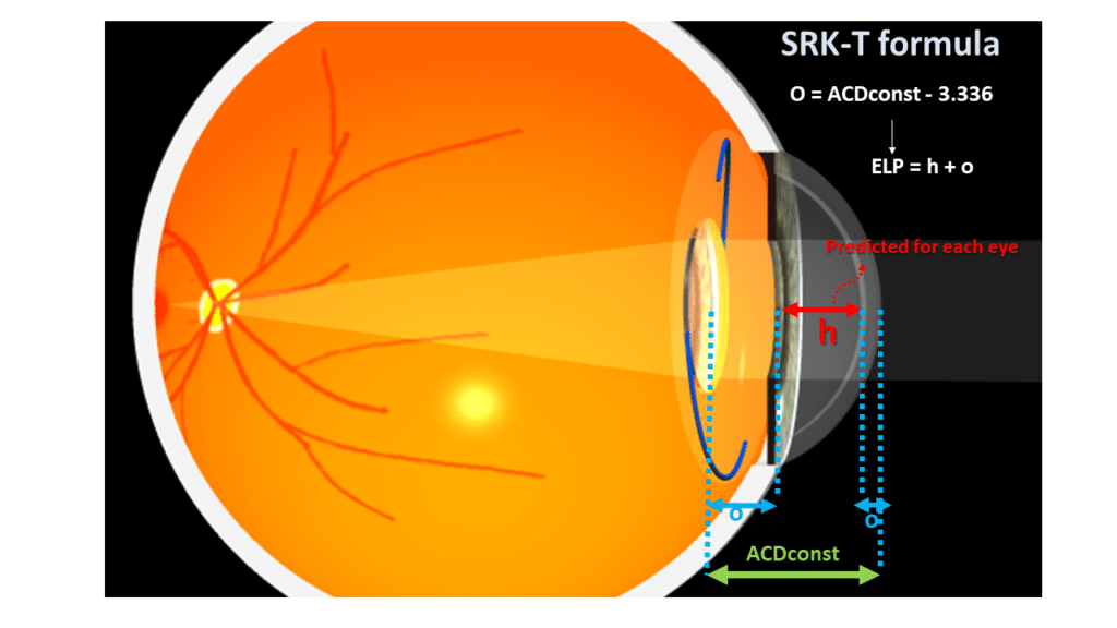 15. Simplified Guide to Optimizing Lens Constant Values of Intraocular ...