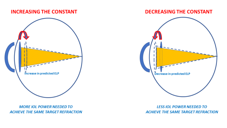 15 Simplified Guide To Optimizing Lens Constant Values Of Intraocular Lens Power Formulas For