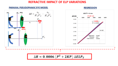 15. Simplified Guide to Optimizing Lens Constant Values of Intraocular ...