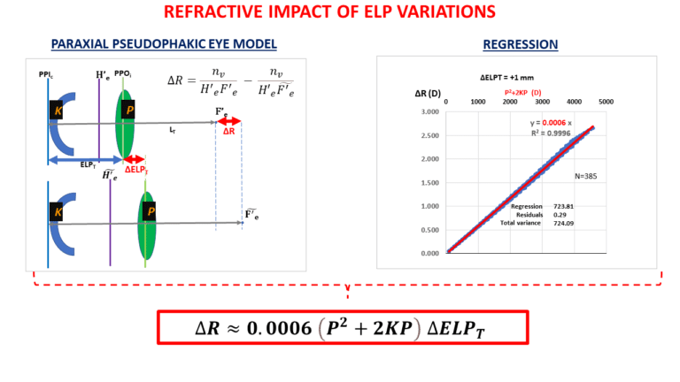 15. Simplified Guide to Optimizing Lens Constant Values of Intraocular ...